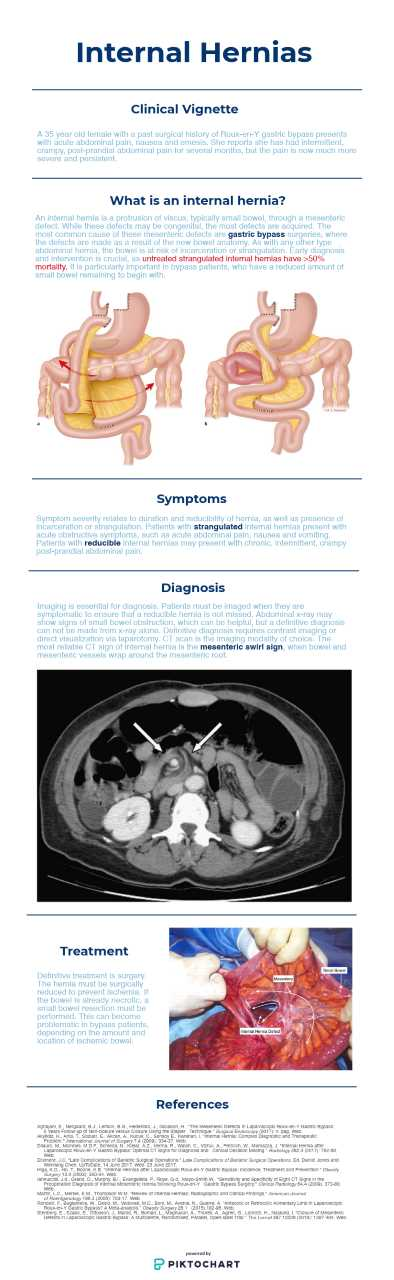 Internal Hernia | Einstein Emergency Medicine
