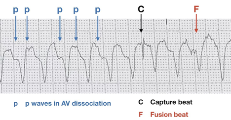 Thrombolytics in the Treatment of STEMI | Einstein Emergency Medicine