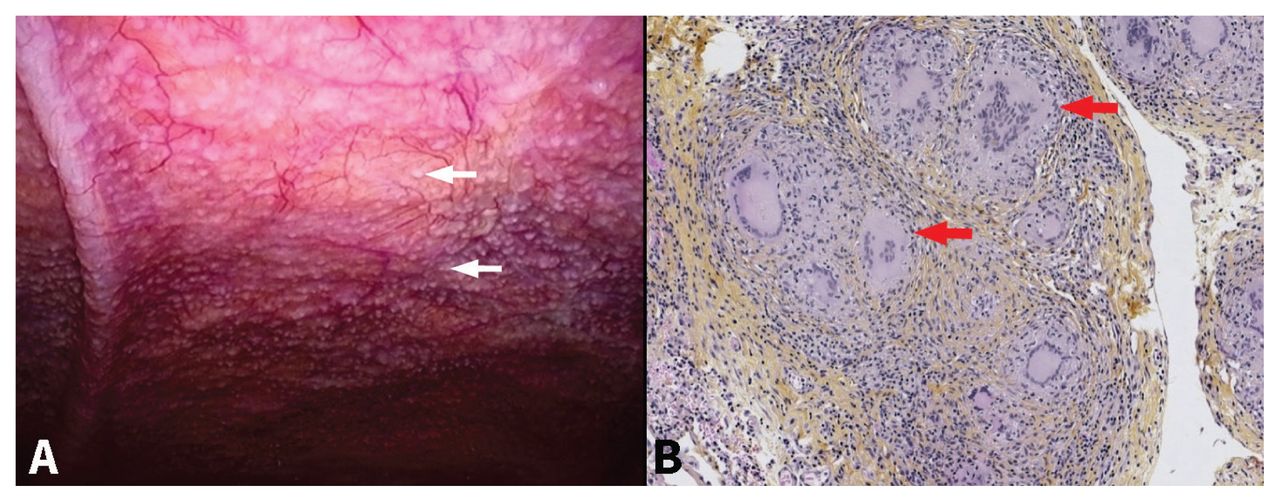 Approach to New Onset Ascites | Einstein Emergency Medicine